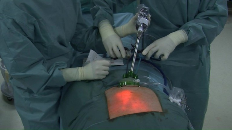 Surgery description - MILOS-Hernia-Repair